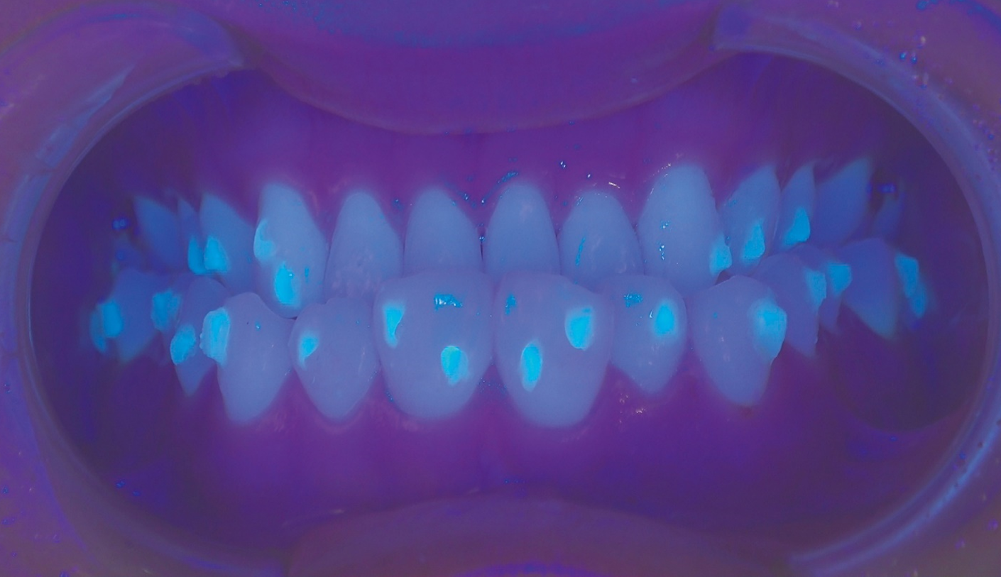 Mielscope Dental Surgical Microscope