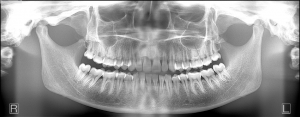 Panoura 18S – The Best Dental Panoramic X-Ray Machine for Your Money