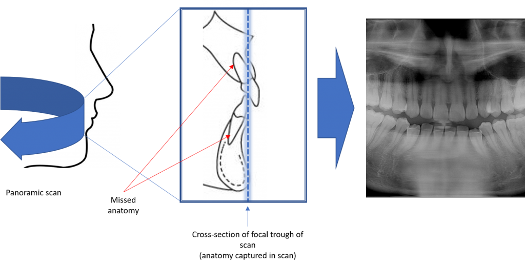 Why Won’t My Panoramic X-Rays Show the Anterior Apices?
