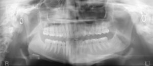 The Eight Most Common Reasons that Your Dental Panoramic X-Ray Image ...