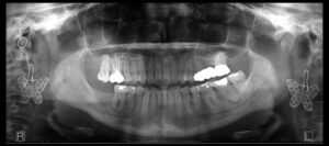 The Eight Most Common Reasons that Your Dental Panoramic X-Ray Image ...