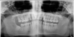 The Eight Most Common Reasons that Your Dental Panoramic X-Ray Image ...