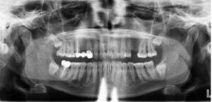 The Eight Most Common Reasons that Your Dental Panoramic X-Ray Image ...