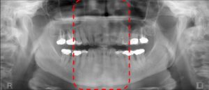 The Eight Most Common Reasons that Your Dental Panoramic X-Ray Image ...
