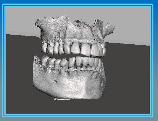 What is DICOM vs. STL in 3D Dentistry?