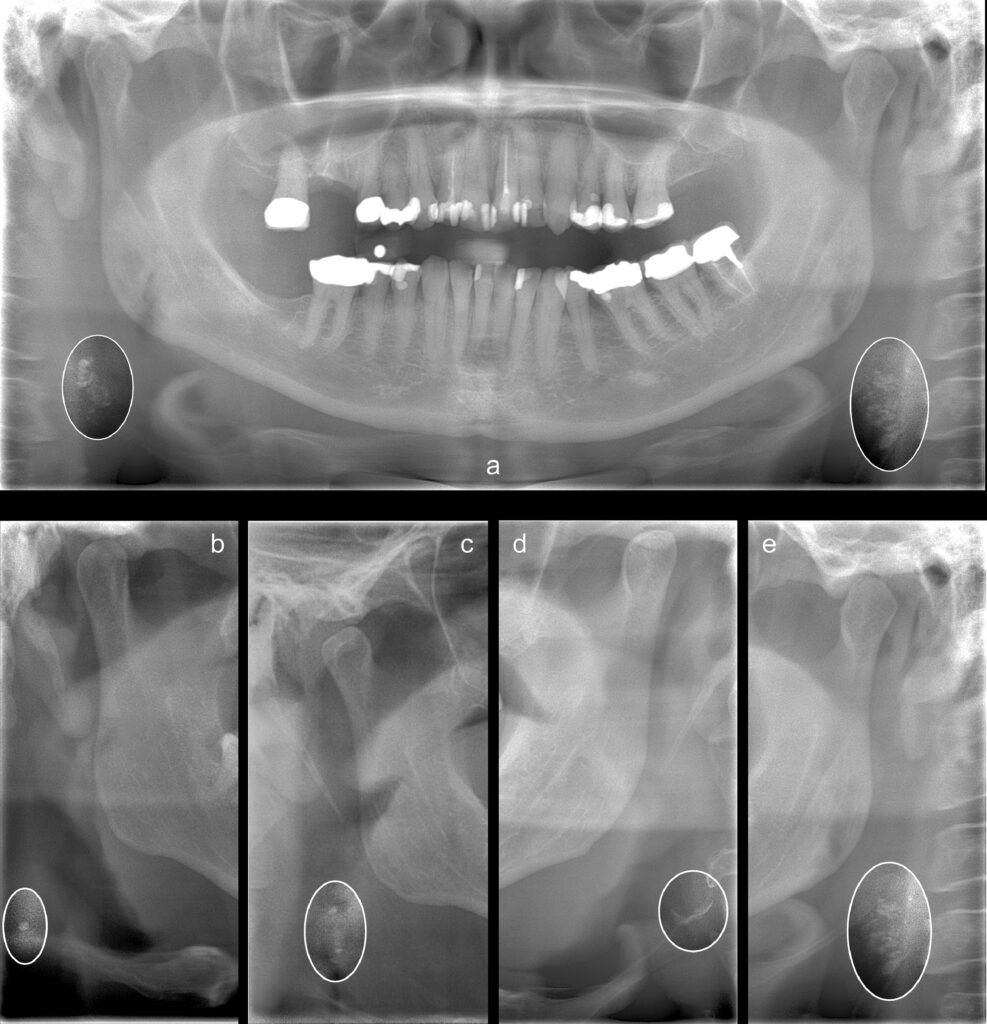 Viewing Calcification of Carotid Arteries in a Panoramic Radiograph